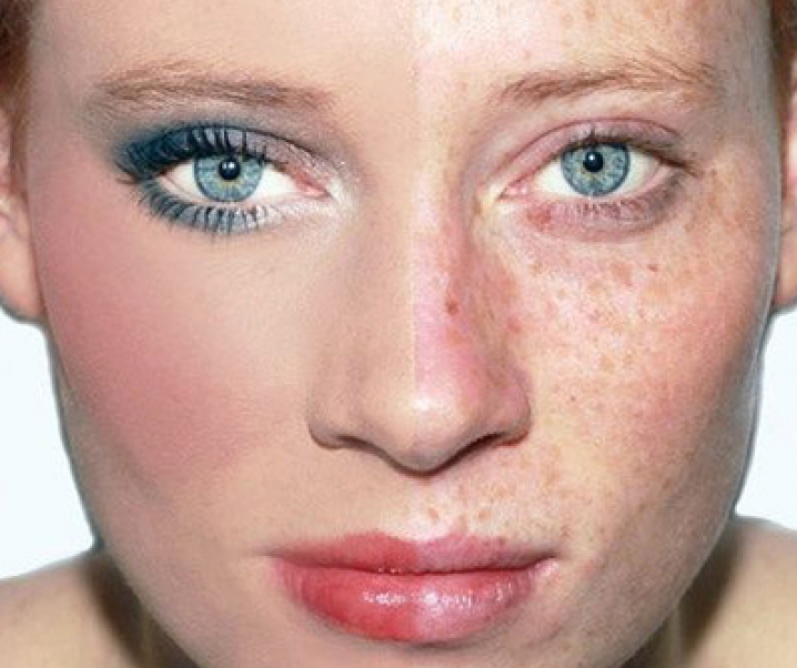Non Surgical Face and Neck-lift, Would You Do It? – ALLIE NYC